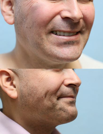 Dimpleplasty Results Orange County | Dr. Michael Jazayeri