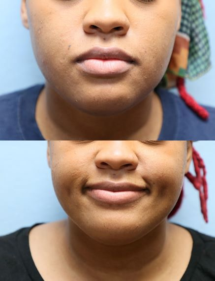 Dimpleplasty Results Orange County | Dr. Michael Jazayeri