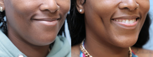 Dimpleplasty Results Orange County | Dr. Michael Jazayeri