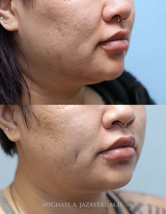 Dimpleplasty Results Orange County | Dr. Michael Jazayeri
