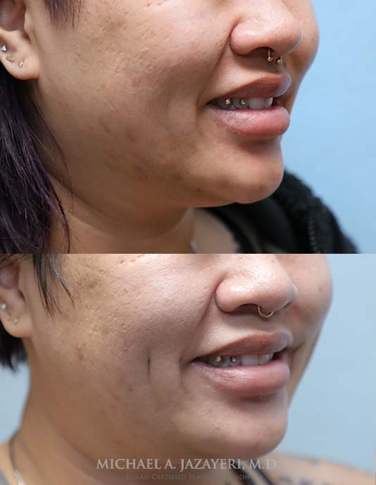 Dimpleplasty Results Orange County | Dr. Michael Jazayeri