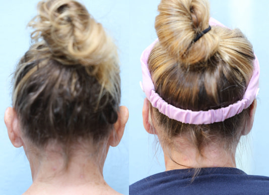 Ear Pinning Results Orange County | Dr. Michael Jazayeri