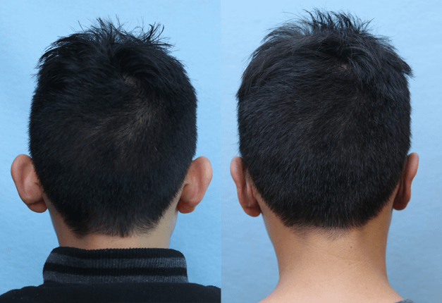 Ear Pinning Before & After in Santa Ana, CA | Dr. Jazayeri