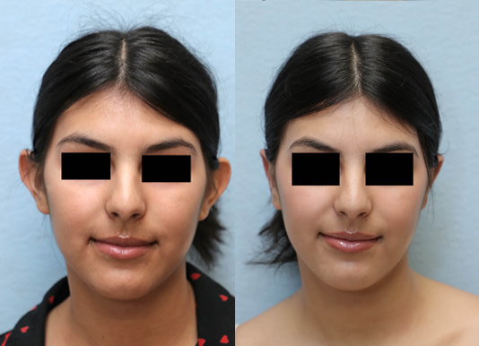 Ear Pinning Before & After in Santa Ana, CA | Dr. Jazayeri