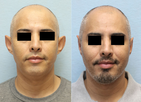 Ear Pinning Before & After in Santa Ana, CA | Dr. Jazayeri