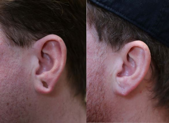 Earlobe Repair Results Orange County | Dr. Michael Jazayeri